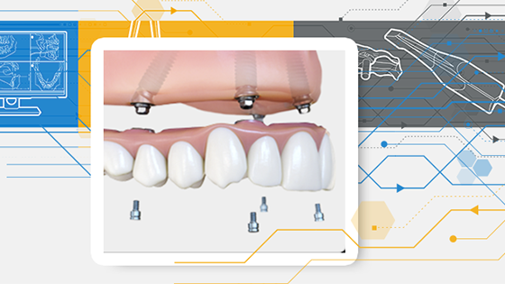 Full arch dentale implantaatworkflow | Dentsply Sirona Benelux Nederland