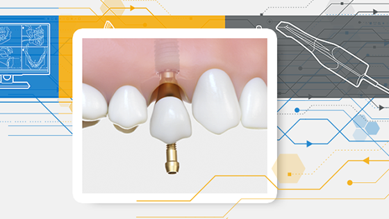 Single Tooth Implant Workflow | Dentsply Sirona Sweden