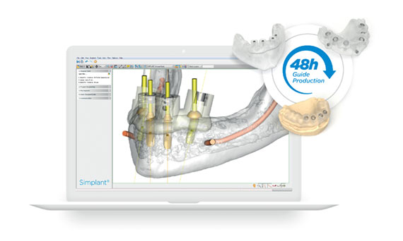 Simplant Implant Planning Software | Dentsply Sirona Sweden