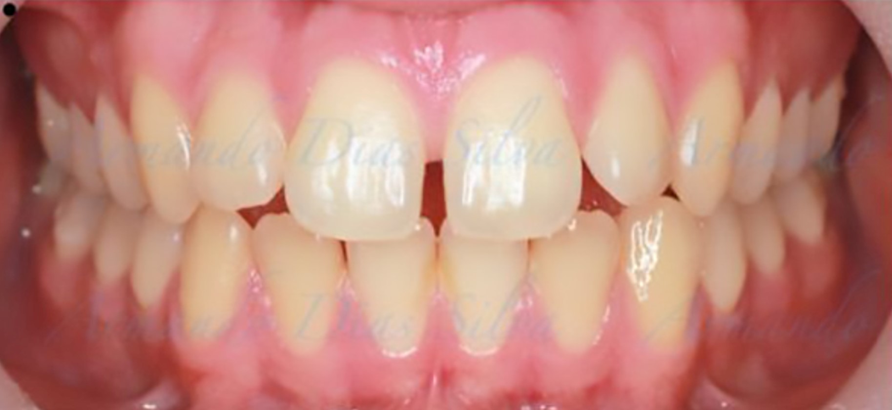 Class II, Div 1 – Central Incisor Protrusion and Anterior Spaces ...