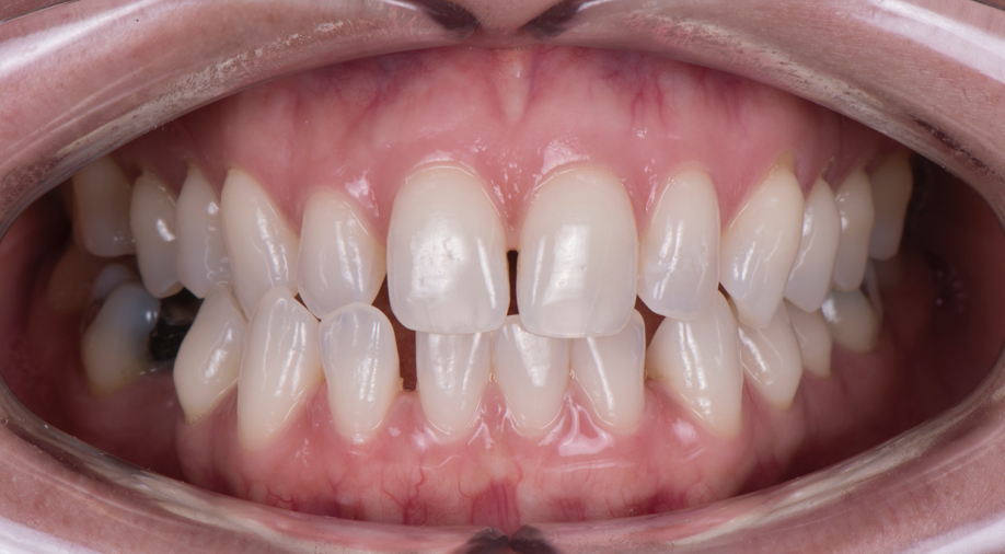 Mild Class 3 Malocclusion: SureSmile Case Study | Dentsply Sirona South ...