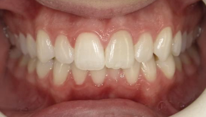 Class I with Class III tendency - Crowding (SureSmile® Aligners) South ...