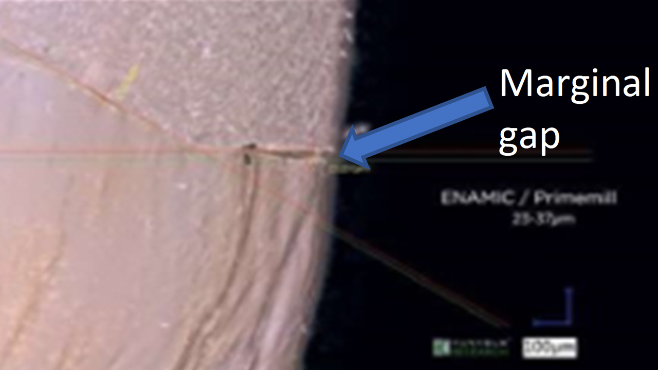Crown Cementation | Dentsply Sirona