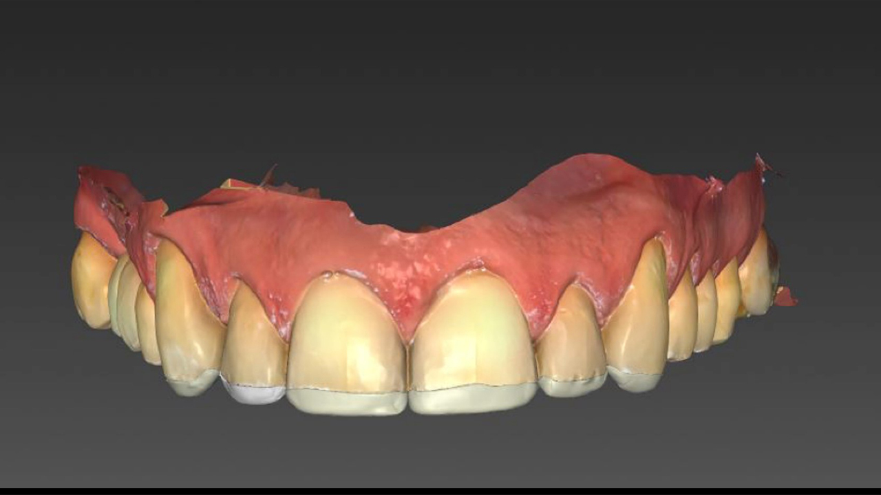 Digital Impressions: Benefits & Use Cases | Dentsply Sirona Serbia