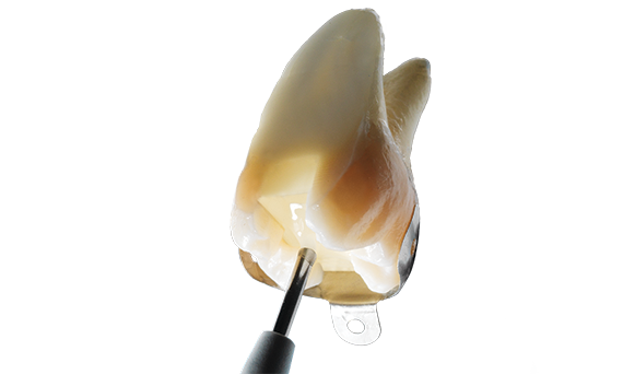 Sdr® Flow Plus Composite Bulk Fill Fluido De Dentsply Sirona Chile