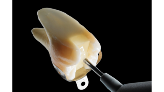 SDR Bulk Fill Flowable Composite: The game changer for posterior ...