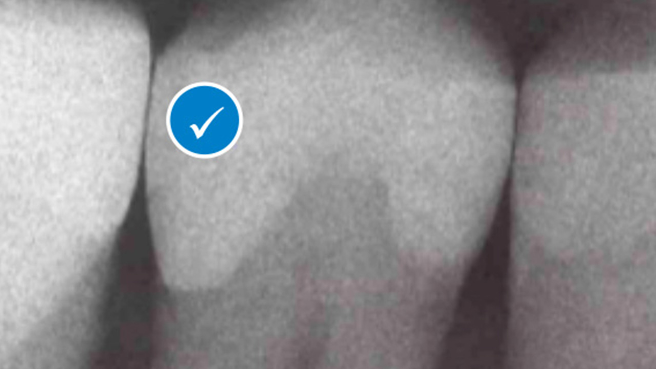 Contact Creation for Class II Restorations | Dentsply Sirona