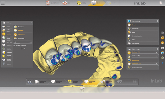 Cercon in the Digital Workflow | Dentsply Sirona USA